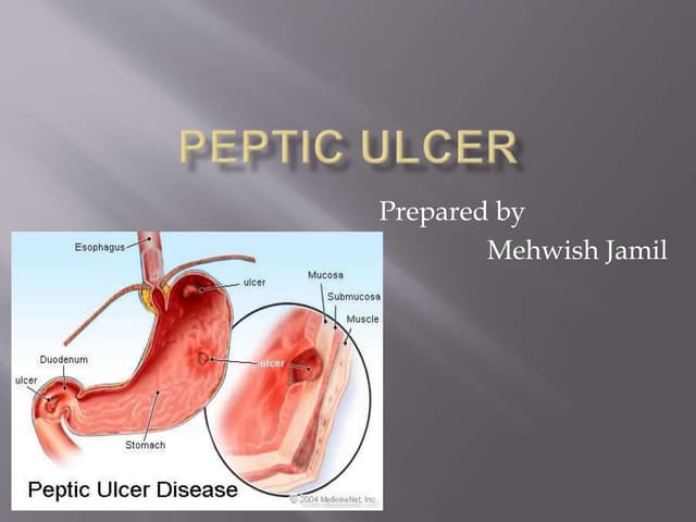 Management of Acute Exacerbation of Peptic Ulcer Disease (PUD) | PDF