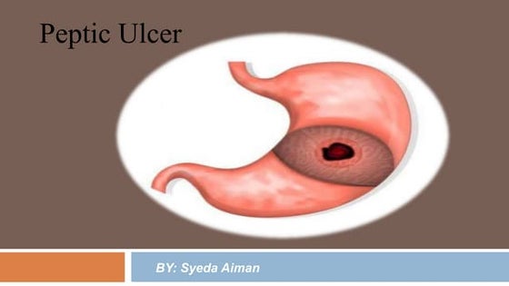 Peptic ulcer | PPT