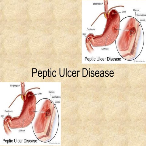 Peptic ulcer | PPT