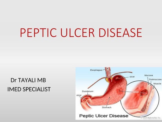 Complications of gastric ulcer and duodenal ulcer (bleeding ...
