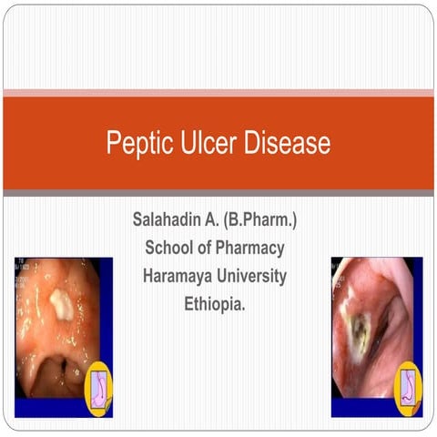 Gastric and duodenal ulcer | PPT