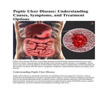 Peptic Ulcer Disease: Understanding Causes, Symptoms, and Treatment ...