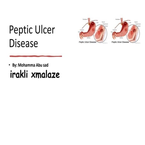 Peptic ulcer | PPT