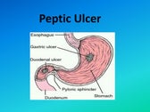 Pathology of Peptic Ulcer Disease | PPT