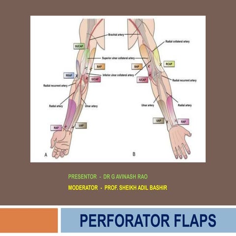 Perforator flaps | PPTX