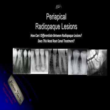 Peri apical radiolucency | PPTX