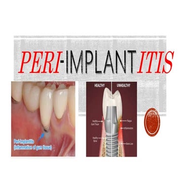 Peri implantitis | PPTX