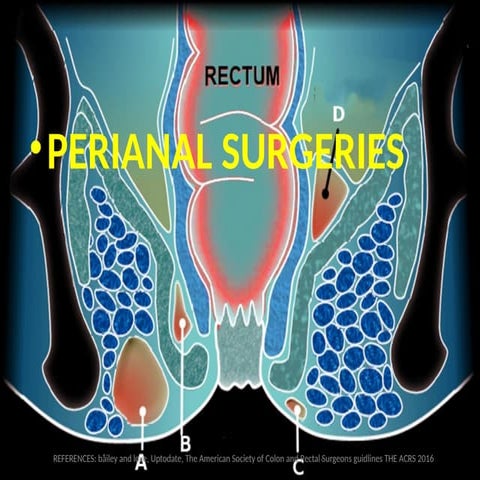 SURGICAL MANAGEMENT OF PERI- ANAL ABCESSES AND INFECTIONS | PPTX