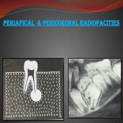 periapical & pericoronal radiopacity.pptx