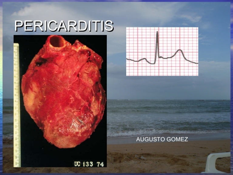 Pericarditis