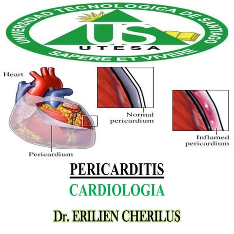 Pericarditis - Cardiologia | PPTX