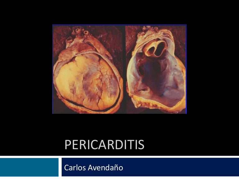 pericarditis epistenocardica – pericarditis guidelines pdf – POGOOA