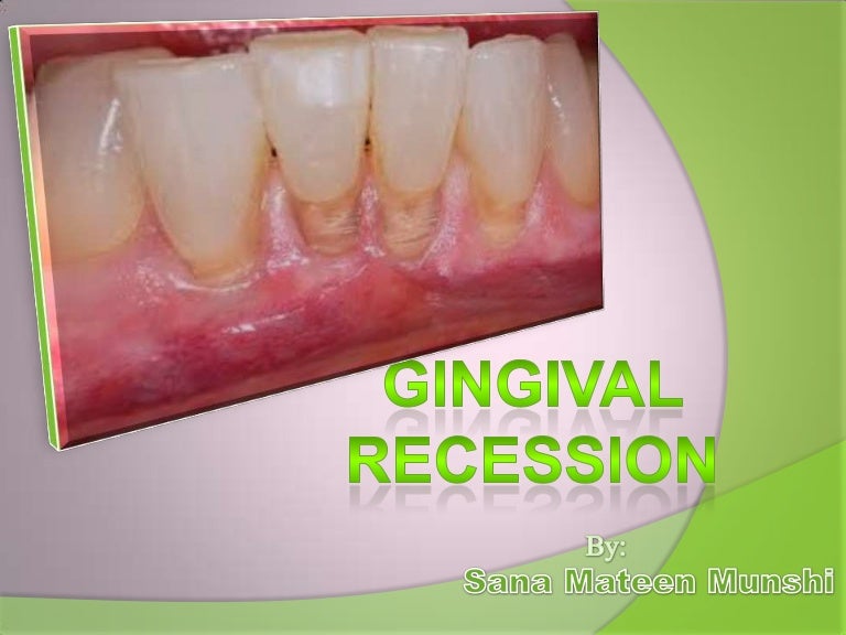 Gingival Recession