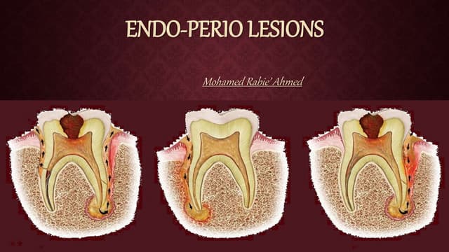 Endodontics periodontal lesions | PPTX | Dental Health | Diseases and ...