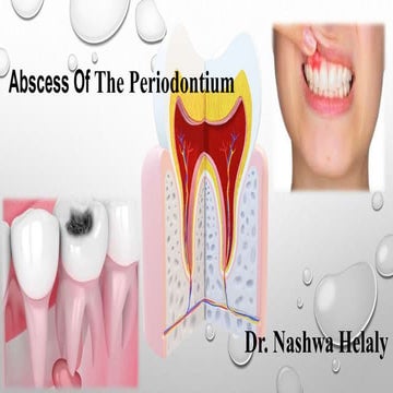 periodontal abscess.pptx