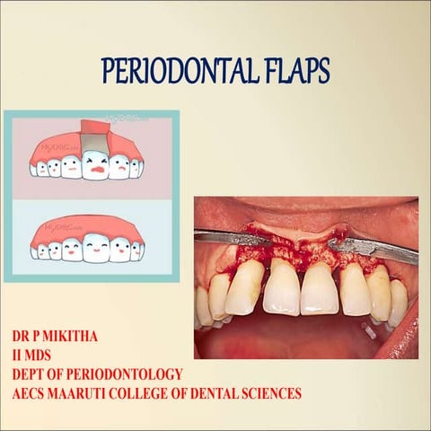 Periodontal flaps | PPT