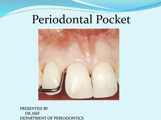 Management of Periodontal Pockets | PPTX