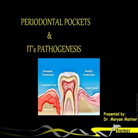 Periodontal pockets & it's pathogenesis | PPTX