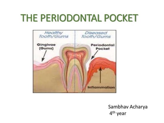 Zones of enamel and dentinal caries completed | PPTX | Dental Health ...