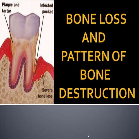 Patterns of bone destruction in periodontics | PPTX