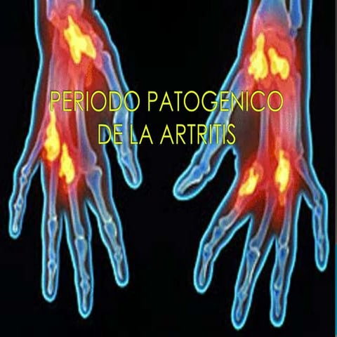Periodo patogenico de la artritis | PPTX | Diseases and Conditions ...
