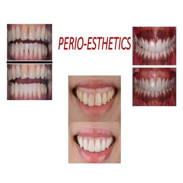 perio esthetics seminar sowji.pptx periodontologyt | PPTX