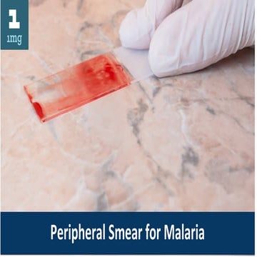 Peripheral smear for malaria | ODP