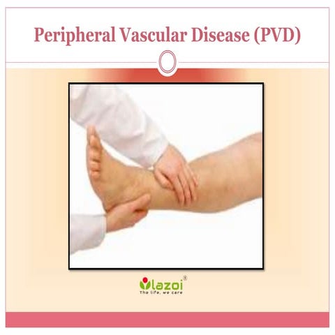 Peripheral vascular disease (pvd) | PPTX