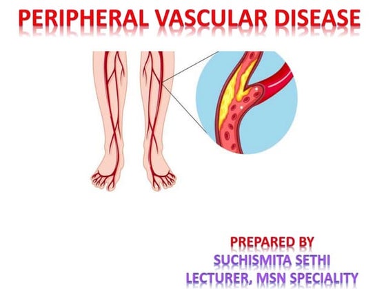 Peripheral vascular disease, | PPTX