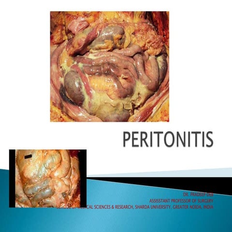 Peritonitis | PPTX
