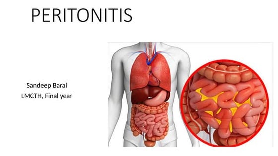 Approach To A Patient With Peritonitis Pptx