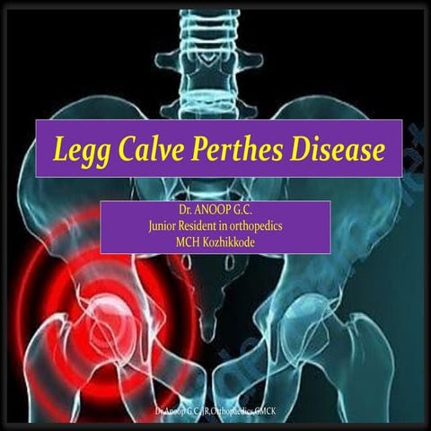 Classification perthes Disease | PDF