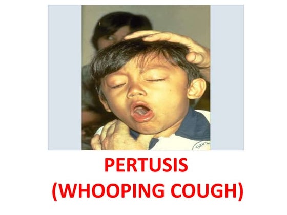 Whooping cough (pertussis) | PPT