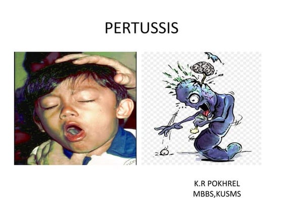 Pertussis | PPT | Infectious Diseases | Diseases and Conditions