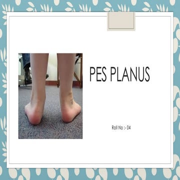 pes planus and pes clavus ppt_083125.pptx