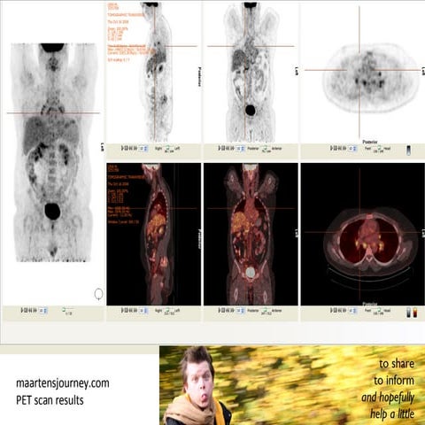 Pet Scan Results | PPT