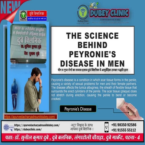 Peyronie’s Disease Best Clinical Sexologist Patna, Bihar India Dr Sunil ...