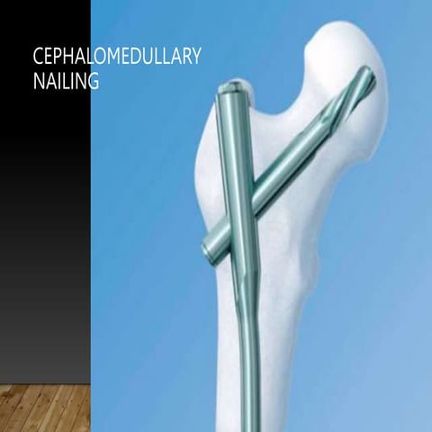 Surgical technique for gama nail | PPTX