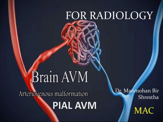 Arteriovenous Malformation (AVM) of Brain | PPT