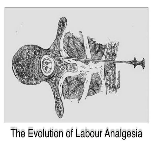PIEB Labour Analgesia | PDF | Healthcare Industry | Industries