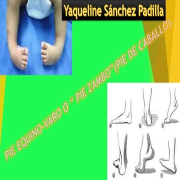 Pie equino varo | PPTX