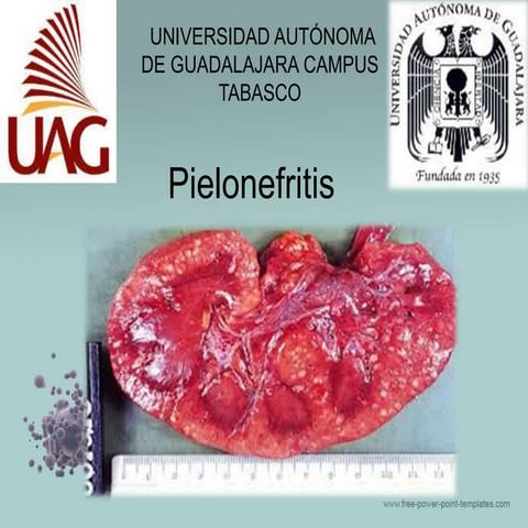 Pielonefritis expo :3 | PPTX