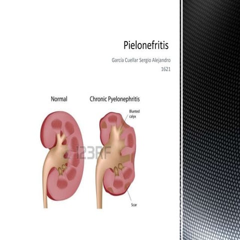Pielonefritis | PPTX