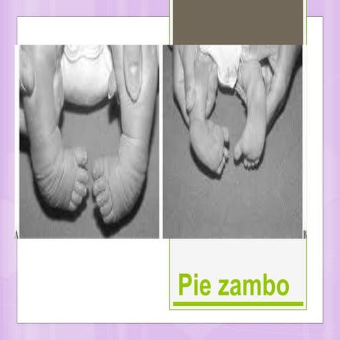 Pie zambo | PPTX