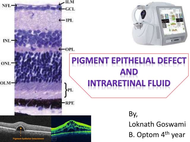 Choroidal nevus and chrpe | PPTX