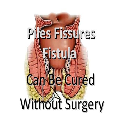 Piles fissures fistula | PPT