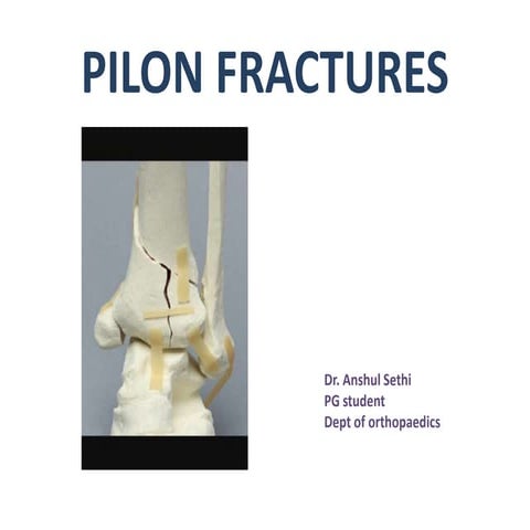 Pilon fracture | PPTX