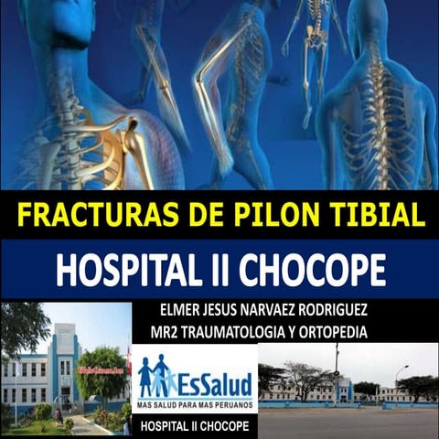 Pilon tibial | PPTX