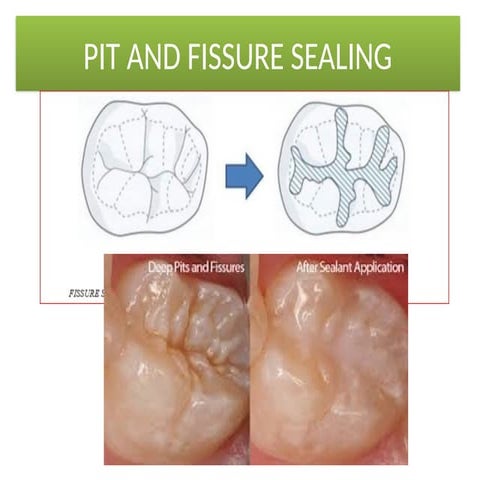 PIT AND FISSURE SEALING.pptx dentistry dental | PPTX