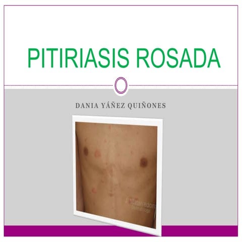 Pitiriasis rosada-1223816048320471-8 | PPTX | Skin and Dermatology ...